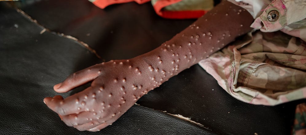 Mpox vaccine production could put Africa first in line