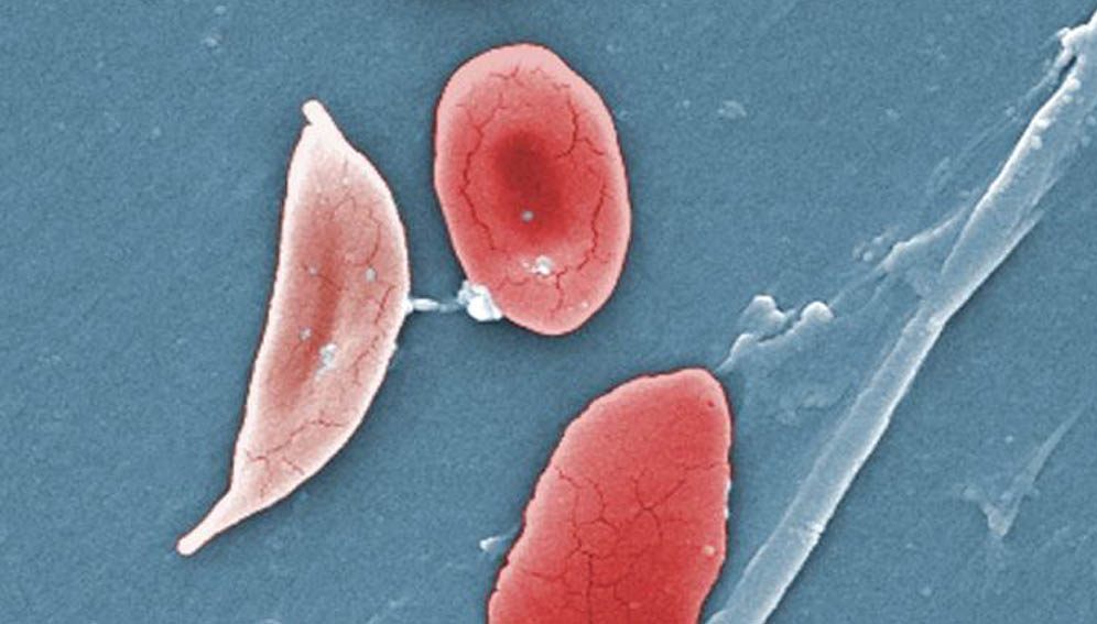 Sickle cell research points to need for DNA testing